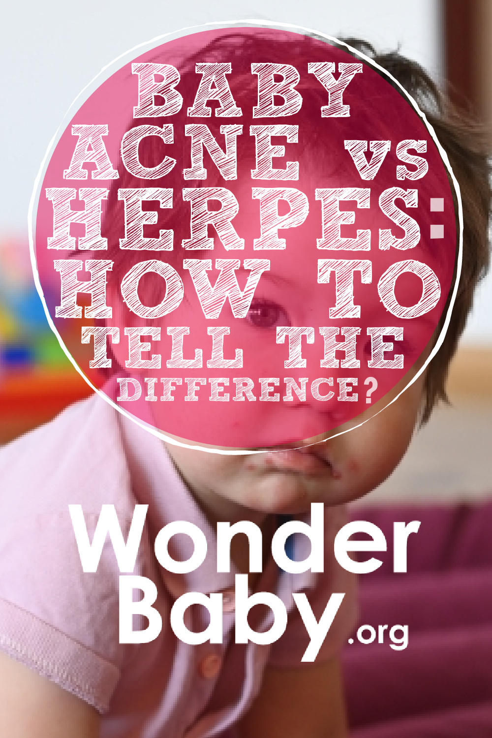 Baby Acne Vs Herpes How To Tell The Difference WonderBaby Baby Acne Vs Herpes How To Tell The Difference WonderBaby